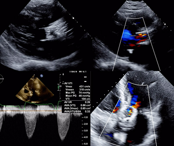 Structural valve deterioration of a supra-annular transcatheter aortic ...