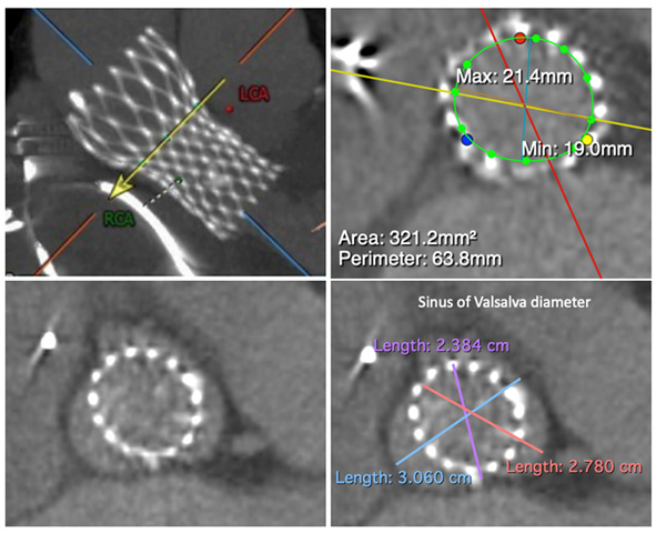 Structural valve deterioration of a supra-annular transcatheter aortic ...