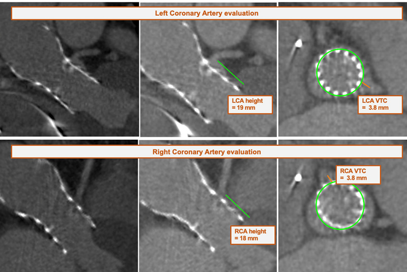Structural valve deterioration of a supra-annular transcatheter aortic ...