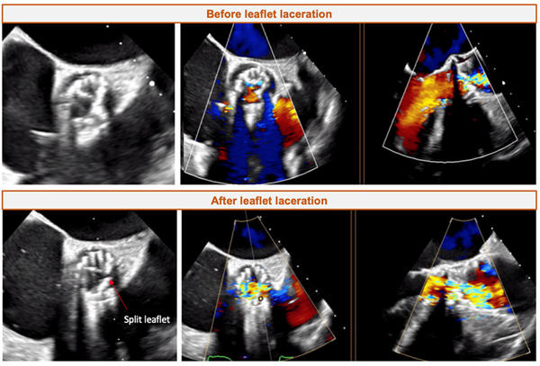 Structural valve deterioration of a supra-annular transcatheter aortic ...