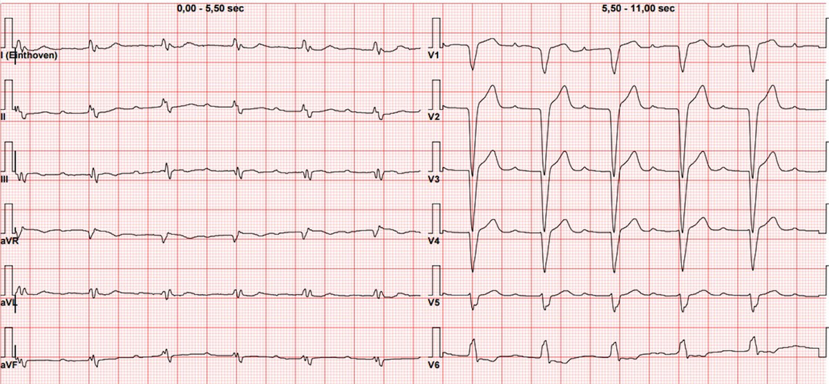 When the first TAVI fails: no panic, just planning