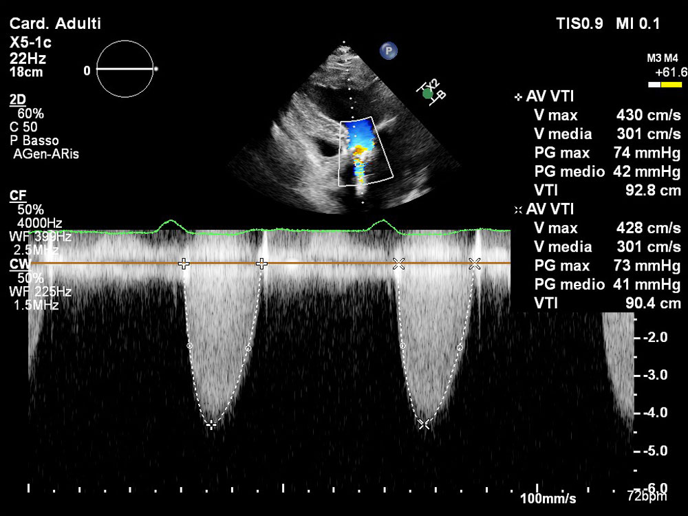 When the first TAVI fails: no panic, just planning