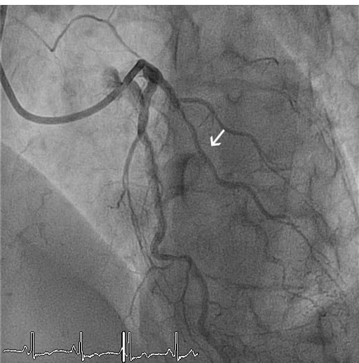 Case study: a Ramus Type III perforation
