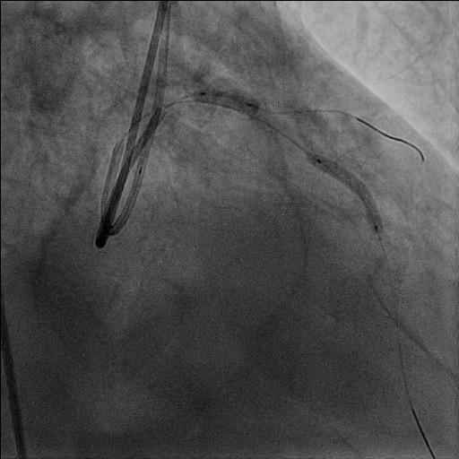 Case study: a calcified LAD Type III perforation