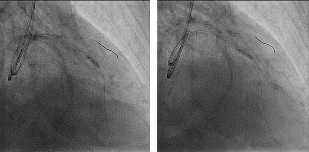 Case study: a calcified LAD Type III perforation