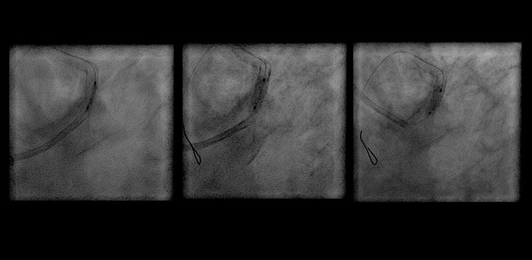 Case study: a calcified LAD Type III perforation