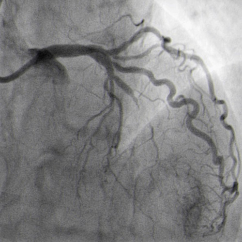 Case study: a coronary Type III perforation during left anterior ...