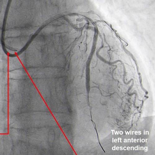 Case study: a coronary Type III perforation during left anterior ...