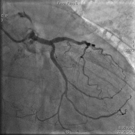 Case study: an iatrogenic perforation of the left main during PCI