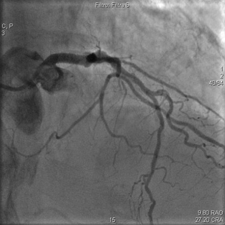 Case study: an iatrogenic perforation of the left main during PCI