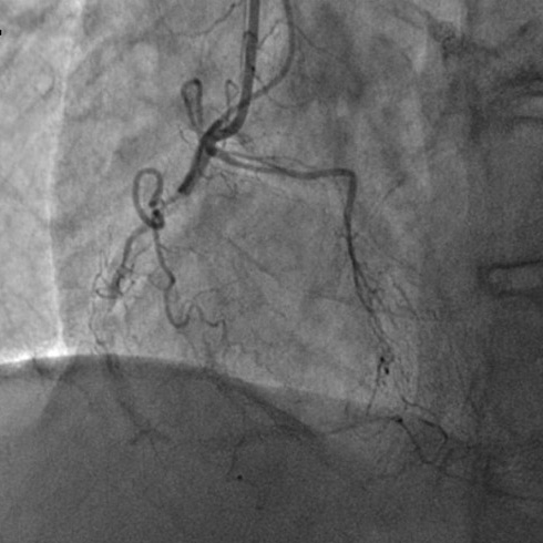 Case study: an iatrogenic perforation of the left main during PCI