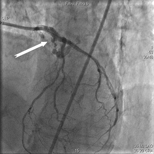 Case study: an iatrogenic perforation of the left main during PCI