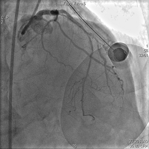 Case study: an iatrogenic perforation of the left main during PCI