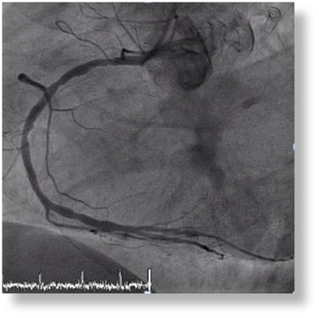 Case study: thrombin injection Type V perforation