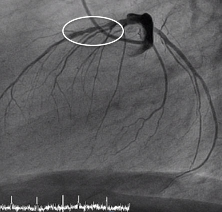 Case study: thrombin injection Type V perforation