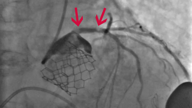 Rotational atherectomy and trans-apical TAVI in severe calcified CAD ...