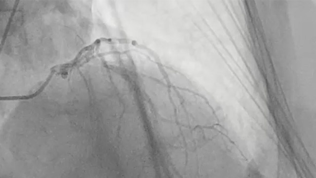 IVUS post-rotablator: the older the calcium, the newer the treatment