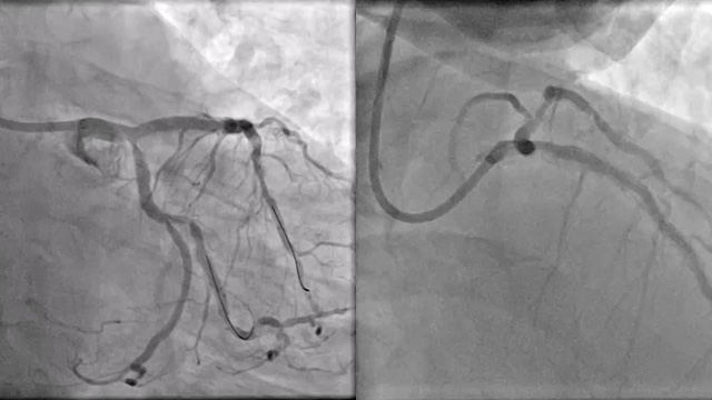 Fighting with calcium is always a struggle