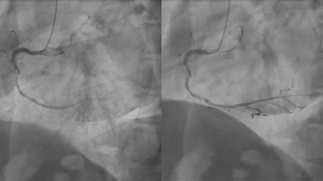 Complex PCI for severely calcified, uncrossable RCA lesion