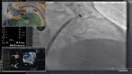 LAA (Left Atrial Appendage) closure