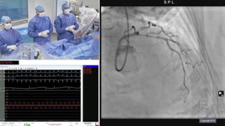 Left main and multivessel disease