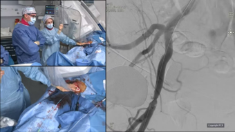 TAVI (Transcatheter aortic valve implantation)