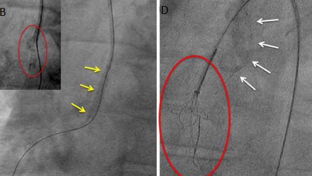 How should I treat an inflated trapped intra-coronary balloon?