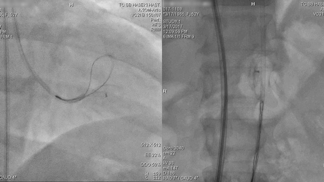 Retrieval of embolised atrial septal occluder device with urology forceps