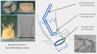 TAVI (Transcatheter aortic valve implantation)