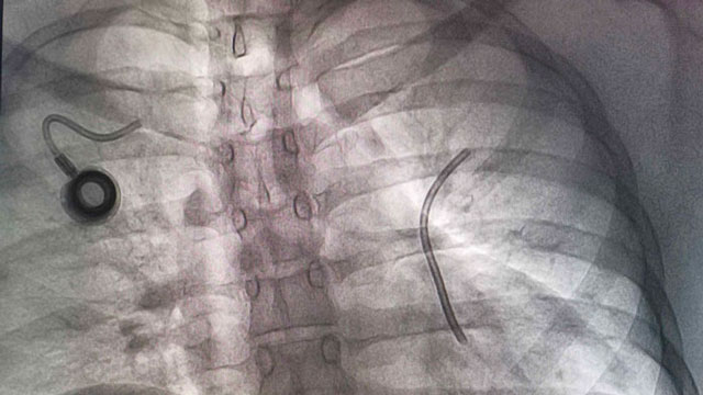 Foreign body case: tell us what you see!