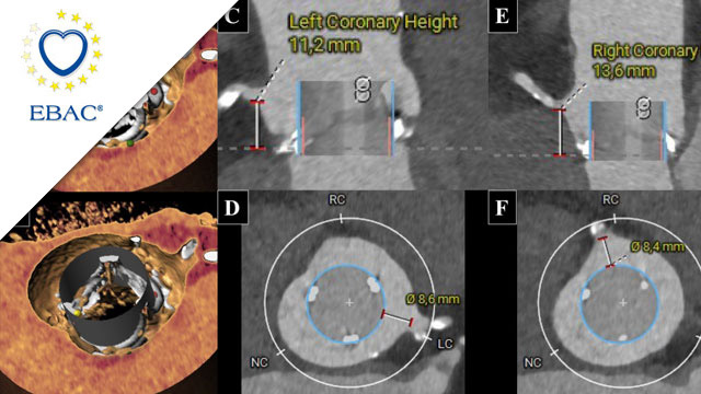 Structural valve deterioration of a small aortic bioprosthesis. How ...