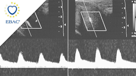 Retrograde access and transcollateral technique for below-the-knee ...