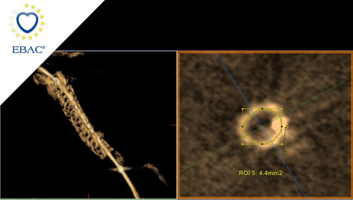 A new angiographic tool to evaluate stent expansion besides ...