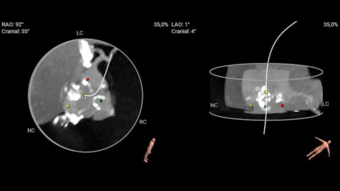 TAVI (Transcatheter aortic valve implantation)