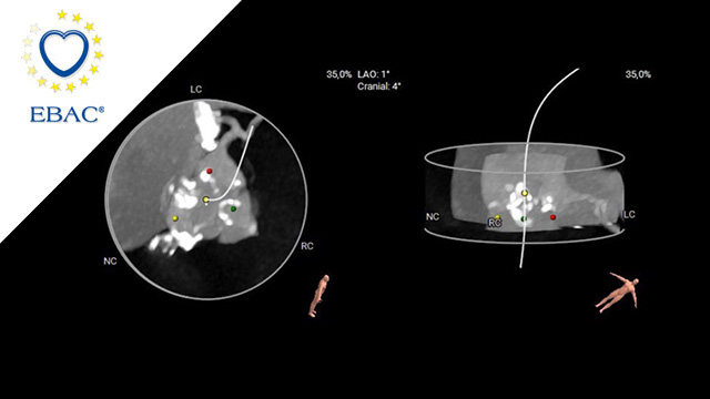 Native TAVI in small annulus with low coronary take-off - Lifetime ...