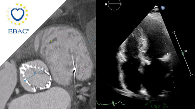 Functional and structural Tricuspid Regurgitation after TAVI with ...