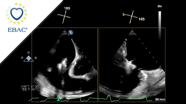 How should I treat a torrential tricuspid valve regurgitation with ...