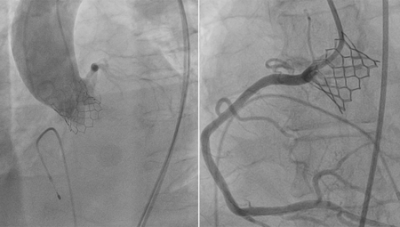 TAVI (Transcatheter aortic valve implantation)