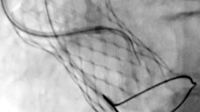 PCRonline.com – By and For the Interventional Cardiovascular Community ...