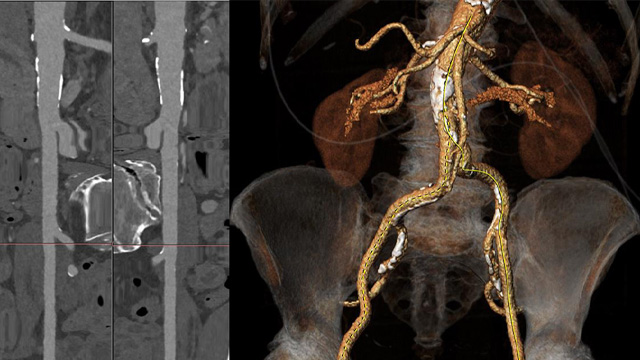 Degenerated bioprosthesis and Bentall surgery: how to track and ...