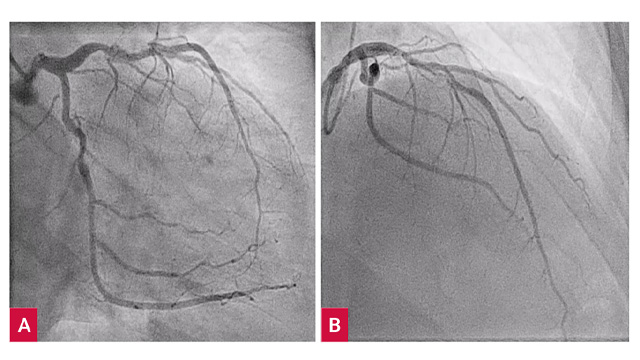 Large thrombus burden management in a young patient with inferior STEMI ...