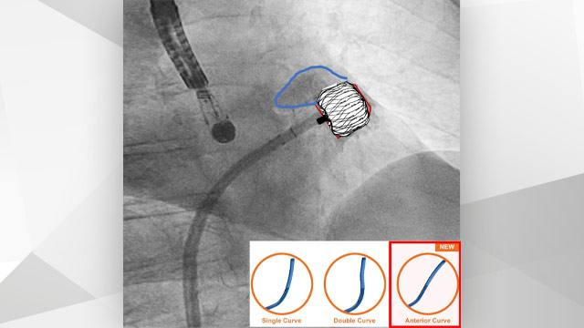 Navigating LAA closure in retrobend chicken-wing anatomy