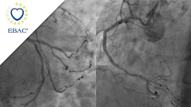 When bleeding risk shapes your PCI strategy