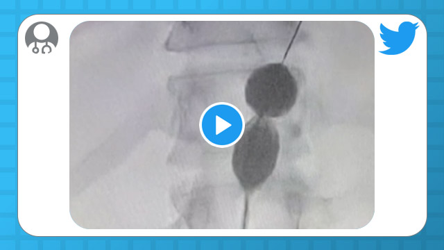 Percutaneous pericardiotomy for recurrent malignant pericardial effusion