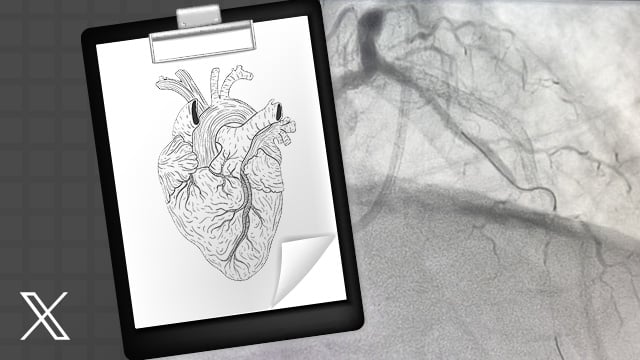 PCI for in-stent restenosis complicated by neoatherosclerosis dissection