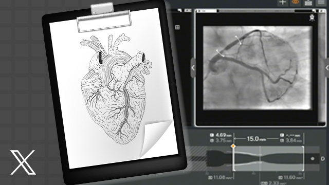 Precision PCI in the era of AI and multimodality imaging