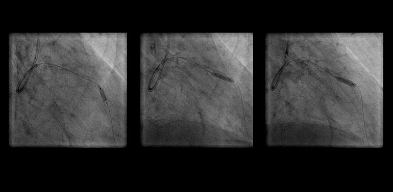 Case study: a calcified LAD Type III perforation