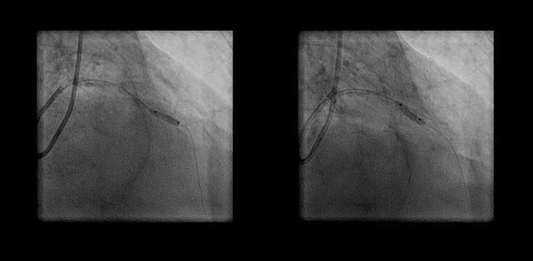 Case study: a calcified LAD Type III perforation