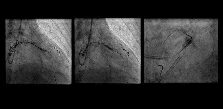 Case study: a calcified LAD Type III perforation