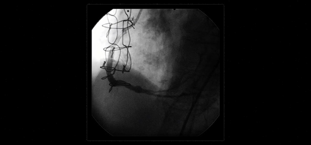 Case study: a SVG to RCA Type IV perforation